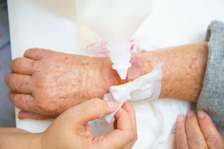 When to Stop Covering Open Wounds: A Wound Care Dilemma - Net Health