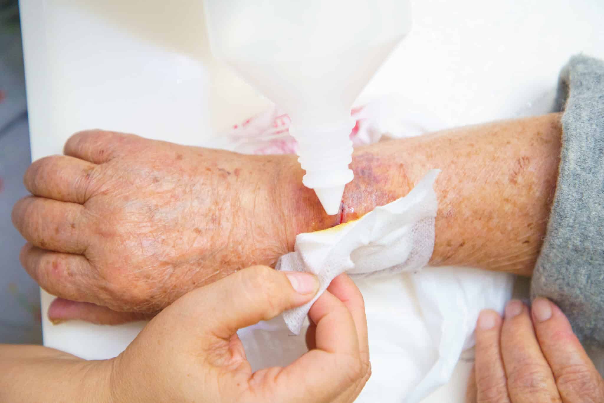 Healthy vs. Infected Wounds: A Clinician's Guide - Net Health
