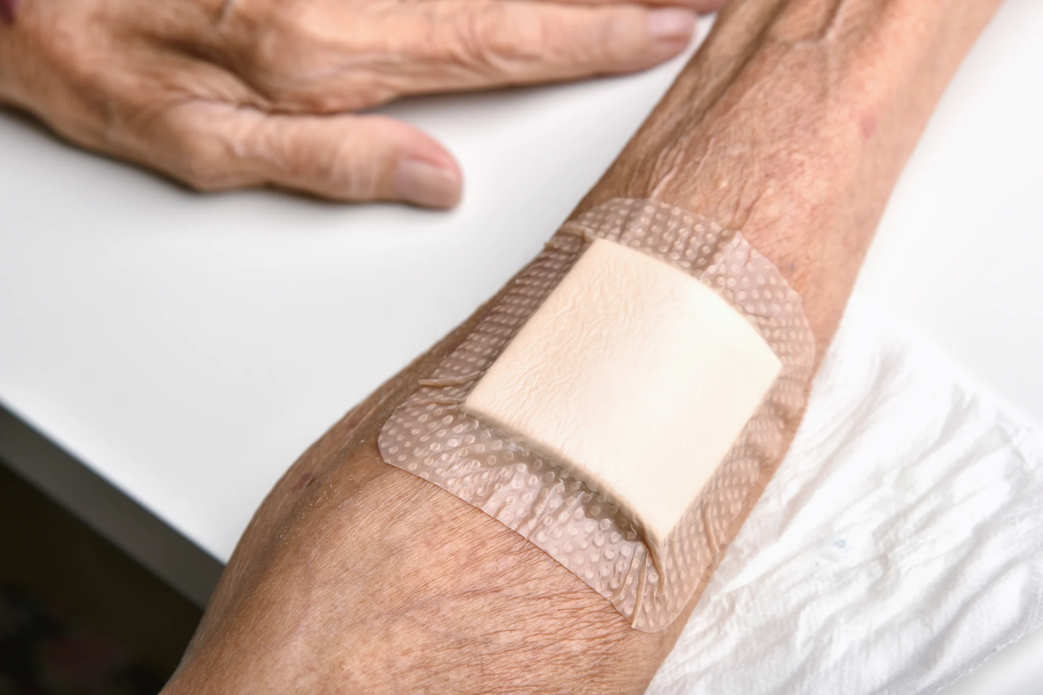 Wound Care After Staples Are Removed: Post-Staple Care Is Critical Care ...